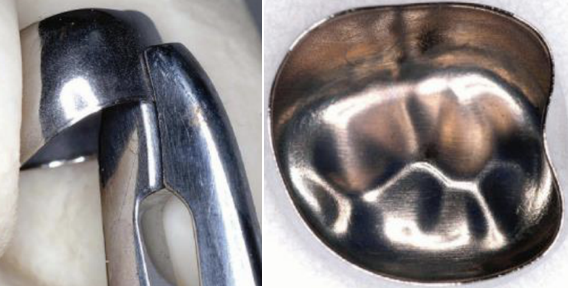 乳牙预成冠-霍尔技术（Hall Technique）的原理及应用。 - 好医术文章 - 好医术-赋能医生守护生命