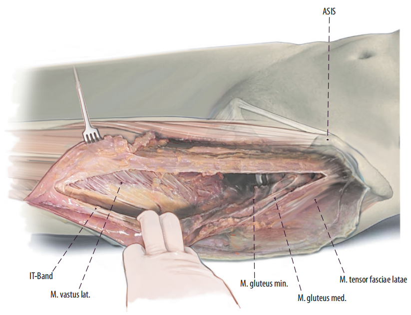 图文并茂：股骨翻修手术中的直接前入路（DAA）技术详解 - 好医术文章 - 好医术-赋能医生守护生命