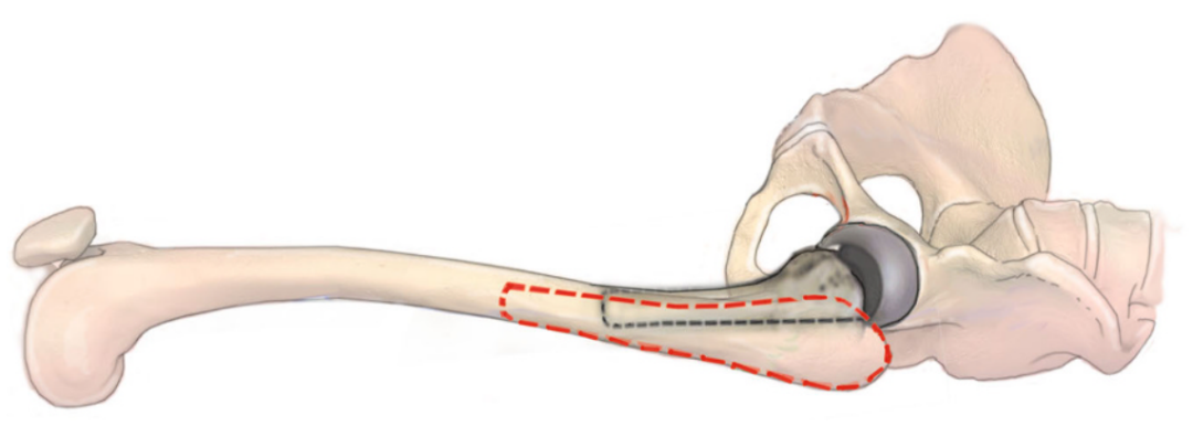 图文并茂：股骨翻修手术中的直接前入路（DAA）技术详解 - 好医术文章 - 好医术-赋能医生守护生命